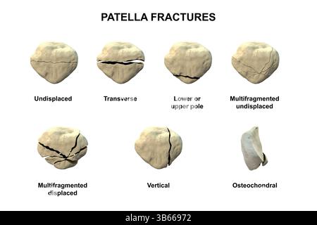 Illustration showing of various patella fractures Stock Photo - Alamy