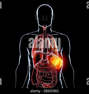 Illustration of a splenomegaly, showing an enlarged spleen. This occurs ...