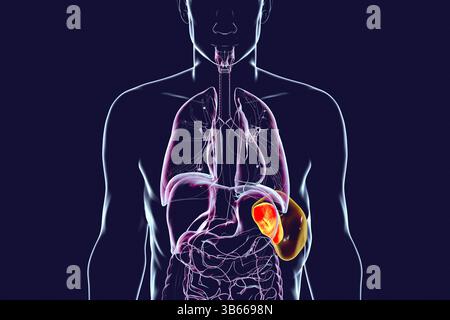 Illustration of a splenomegaly, showing an enlarged spleen. This occurs ...