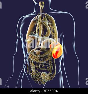 Illustration of a splenomegaly, showing an enlarged spleen. This occurs ...