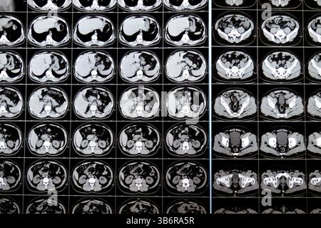 Kidney stone, CT scan Stock Photo - Alamy
