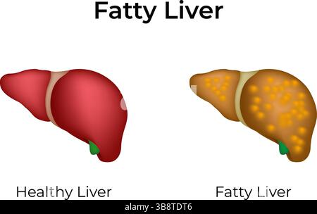 Fatty Liver vs Healthy Liver Design Vector Illustration Stock Vector ...