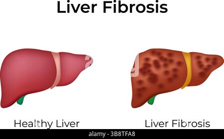 Liver Fibrosis Healthy vs Diseased Liver Design Vector Illustration ...
