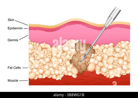 illustration of educational cutout diagram of human skin showing the ...