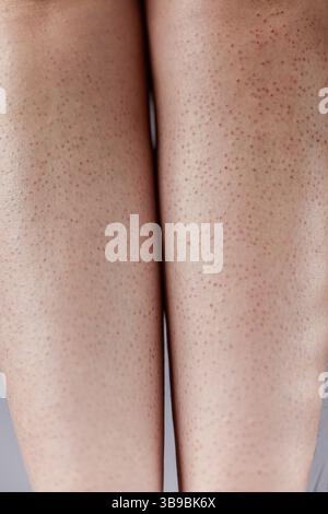 Female legs with red irritation and visible hair after painful ...