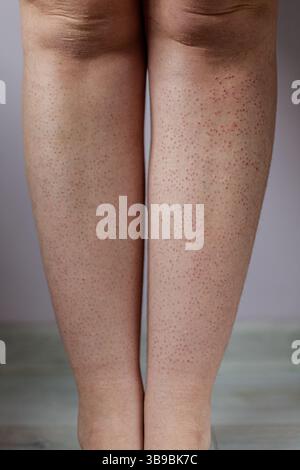 Female legs with red irritation and visible hair after painful ...