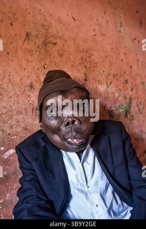 Godfrey Bagume, Sebabi, Fibrodysplasia Ossificans Progressiva (FOP ...