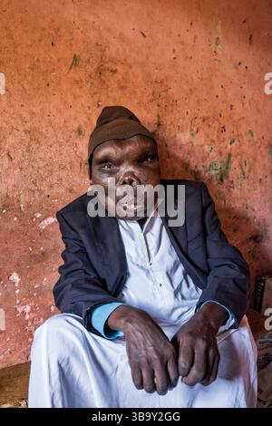 Godfrey Bagume, Sebabi, Fibrodysplasia Ossificans Progressiva (FOP ...