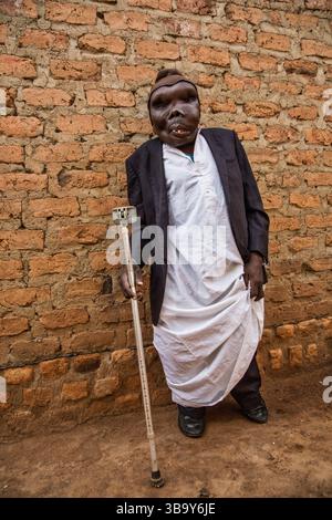 Godfrey Bagume, Sebabi, Fibrodysplasia Ossificans Progressiva (FOP ...