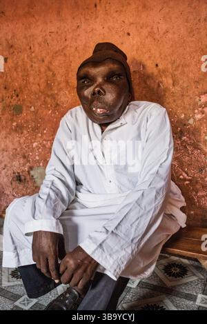 Godfrey Bagume, Sebabi, Fibrodysplasia Ossificans Progressiva (FOP ...