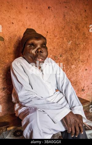 Godfrey Bagume, Sebabi, Fibrodysplasia Ossificans Progressiva (FOP ...