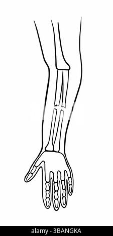 Vector isolated illustration of a closed forearm fracture. Outline ...