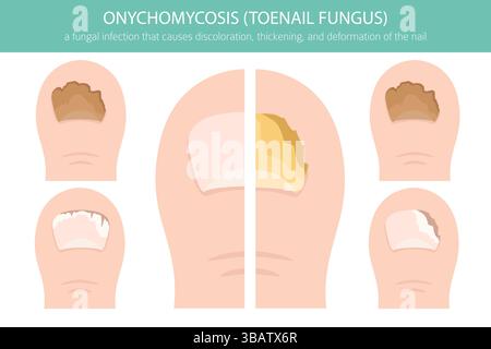 Medical vector illustration of onychomycosis – a common fungal toenail ...