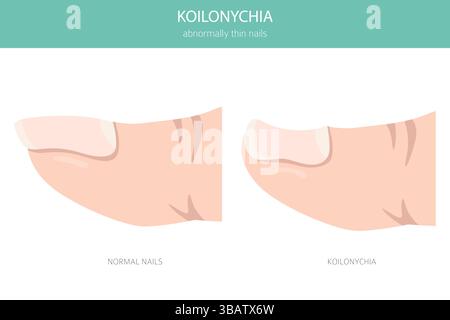 Koilonychia, or spoon nails, is a nail condition where nails become ...