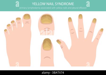 Yellow Nail Syndrome is a rare condition marked by thick, slow-growing ...