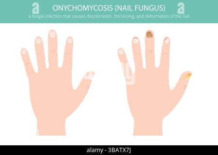 Medical vector illustration of onychomycosis – a common fungal toenail ...