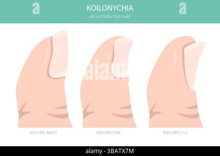 Koilonychia, or spoon nails, is a nail condition where nails become ...