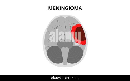 Illustration of a meningioma. This is a tumour that grows from the ...