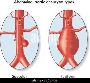 Abdominal aortic aneurysm vector illustration Stock Vector Image & Art ...