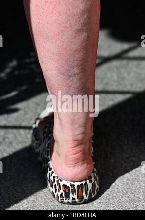 Middle aged woman with badly bruised calf muscle and ankle on back of ...