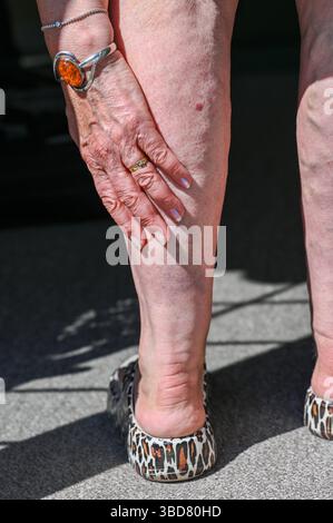 Middle aged woman with badly bruised calf muscle and ankle on back of ...