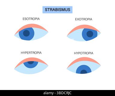 Illustration of strabismus. Also known as eye misalignment, this is a ...