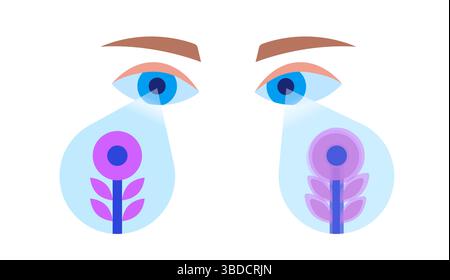 Illustration of amblyopia, also called lazy eye. This is reduced vision ...
