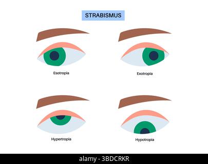 Illustration of strabismus. Also known as eye misalignment, this is a ...