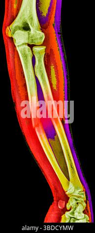 Coloured X-ray of a lower arm with fractures in both the ulna and ...
