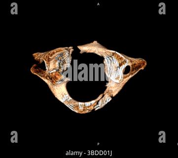 Spinal injury. Coloured 3D computed tomography (CT) scan of the lumbar (lower) spine of a 57 ...