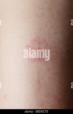 Ringworm fungal infection on the skin of the groin (inguinal area) in a ...