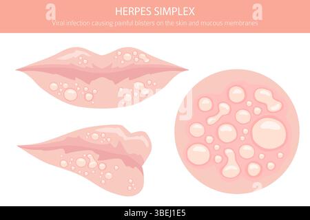 Herpes Simplex. Skin diseases. Medical infographic design. Vector ...