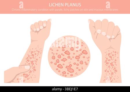 Lichen Planus. Skin diseases. Medical infographic design. Vector ...