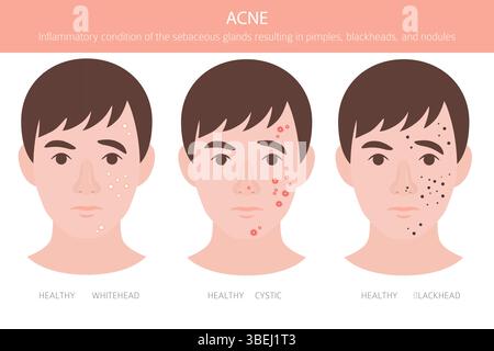 Acne skin condition. Skin diseases. Medical infographic design. Vector ...