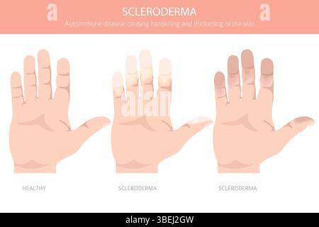 Scleroderma. Skin diseases. Medical infographic design. Vector ...