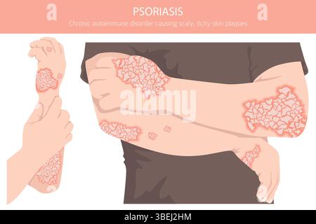 Psoriasis. Skin diseases. Medical infographic design. Vector ...