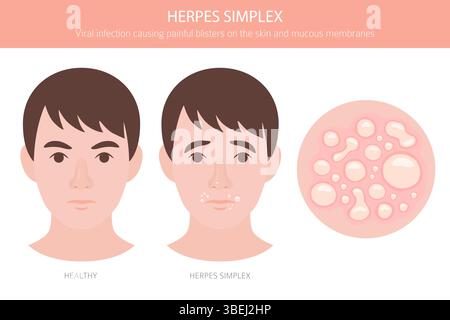 Herpes Simplex. Skin diseases. Medical infographic design. Vector ...
