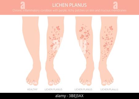 Lichen Planus. Skin diseases. Medical infographic design. Vector ...