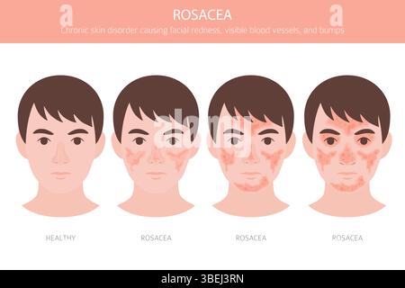 Rosacea. Skin diseases. Medical infographic design. Vector illustration ...