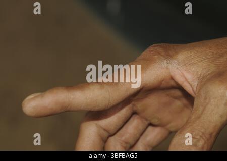 Monocled cobra bite, snake bite (Naja kaouthia Stock Photo - Alamy