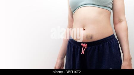 Vein hematoma after blood sampling Stock Photo - Alamy