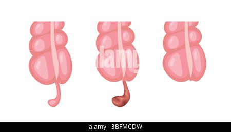 Illustration of inflamed appendix and abdominal pain Stock Vector Image ...