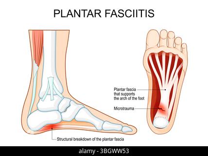Illustration of foot pain and plantar fasciitis symptoms Stock Vector ...