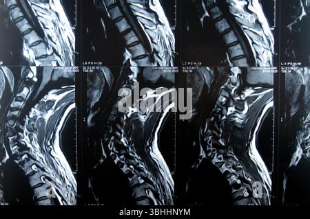 MRI of cervical spine reveals Spondylodegenerative changes along the ...