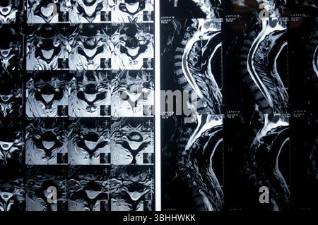 MRI of cervical spine reveals Spondylodegenerative changes along the ...