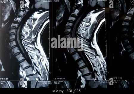 MRI of cervical spine reveals Spondylodegenerative changes along the ...