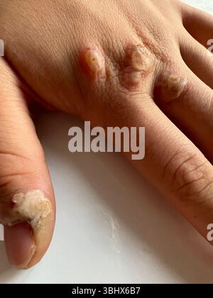Hand with many scars after wart removal by chemical freezing. Damage to ...