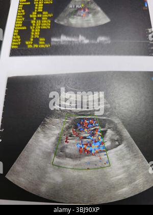 Normal renal sonographic examination with normal duplex doppler study ...