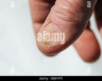 damaged finger nail nail plate with wound inflammation close-up. Hand ...