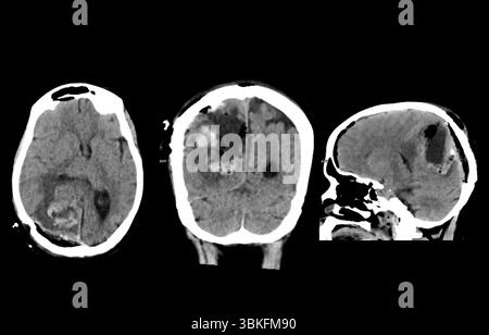 Computed tomography (CT) scans of the brain of a patient showing an ...